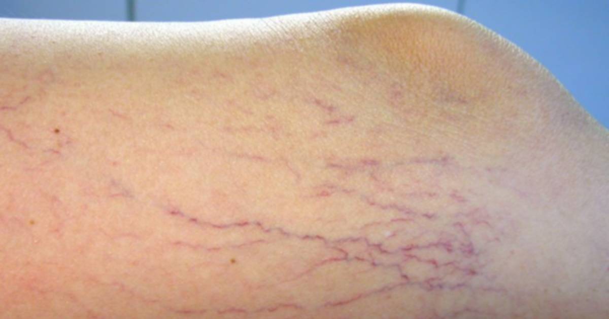 Varices: insuficiencia venosa crónica