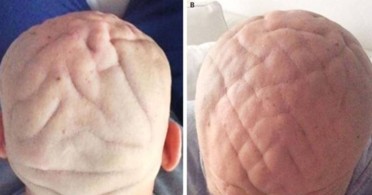 El extraño caso de un hombre cuya cabeza pelada tiene forma de cerebro